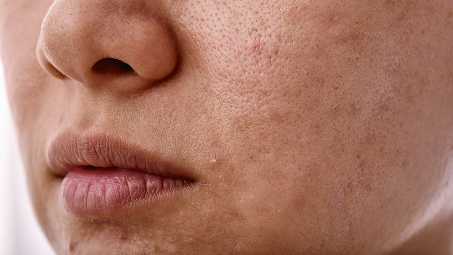 What are Blackheads? | Tips for Blackheads | Garnier UK
