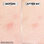 Garnier 8H Blemish Patch for Clearer Skin | Pure Active | Garnier UK