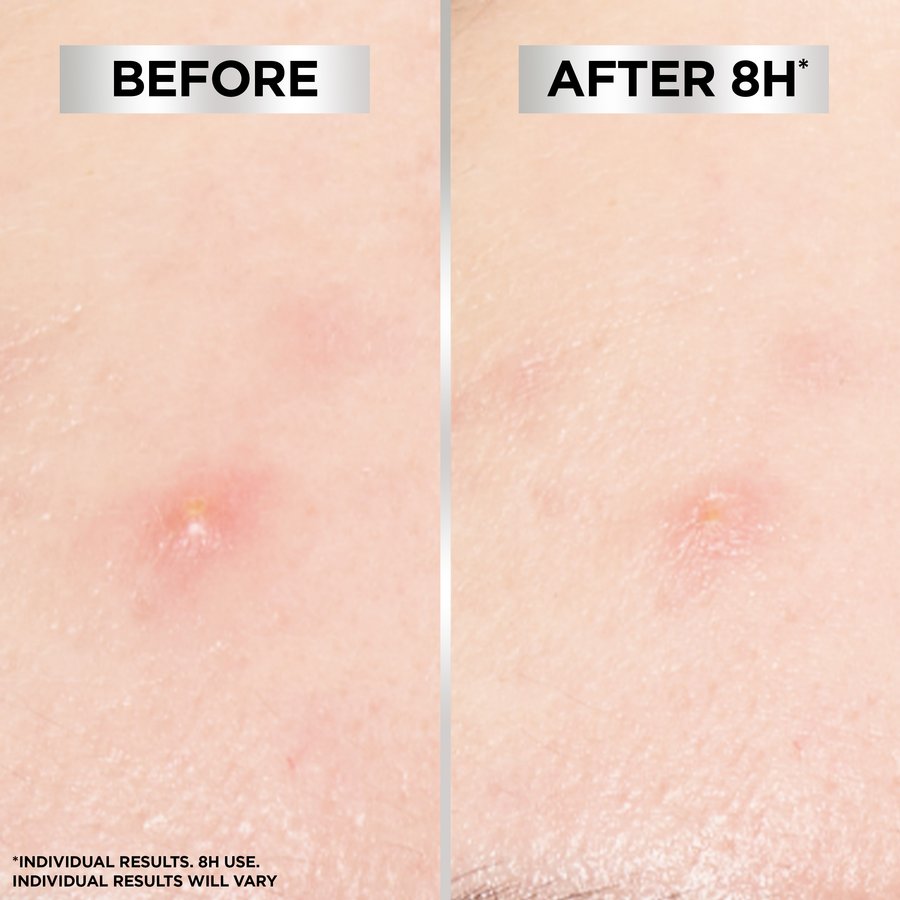 Garnier 8H Blemish Patch for Clearer Skin | Pure Active | Garnier UK