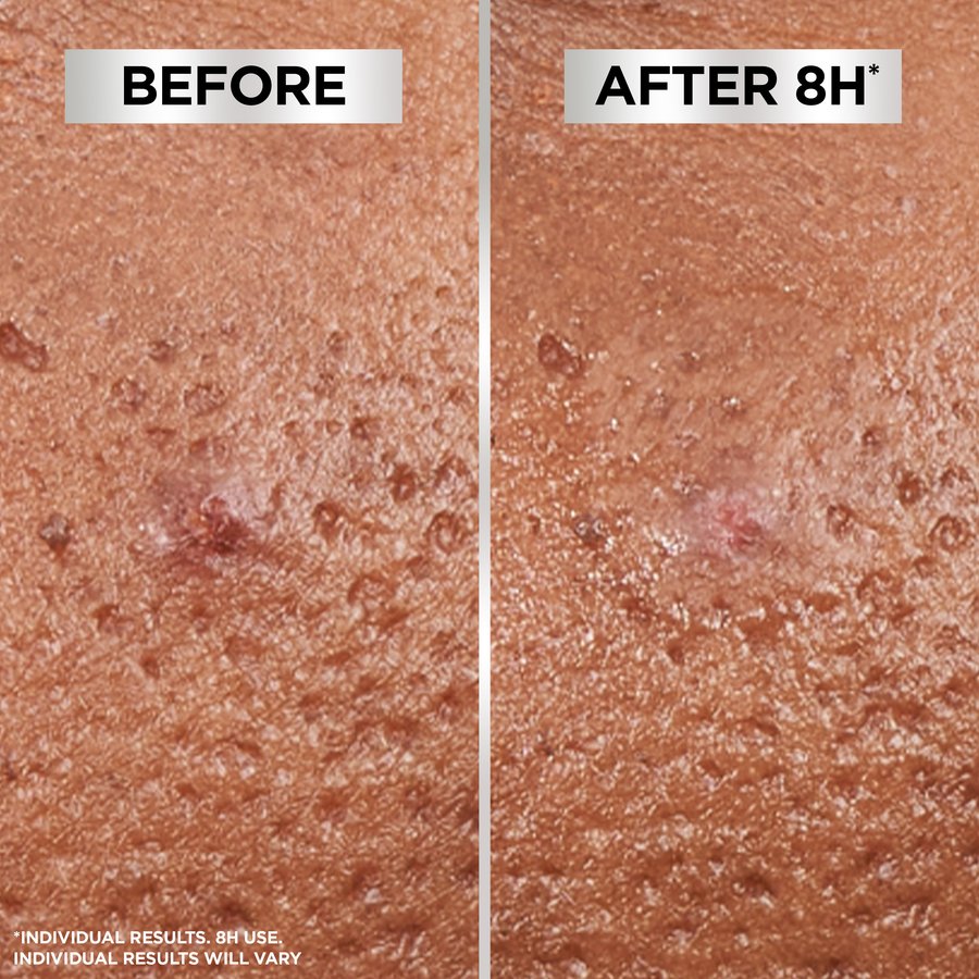 Garnier 8H Blemish Patch for Clearer Skin | Pure Active | Garnier UK